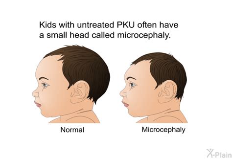 Patedu Phenylketonuria Or Pku