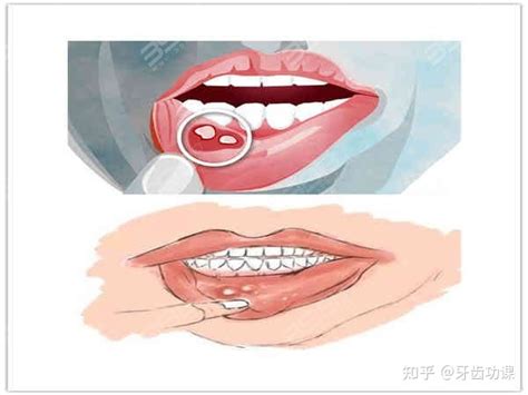 别再吃槟榔啦，整理几个嚼槟榔对口腔以及身体的危害 知乎