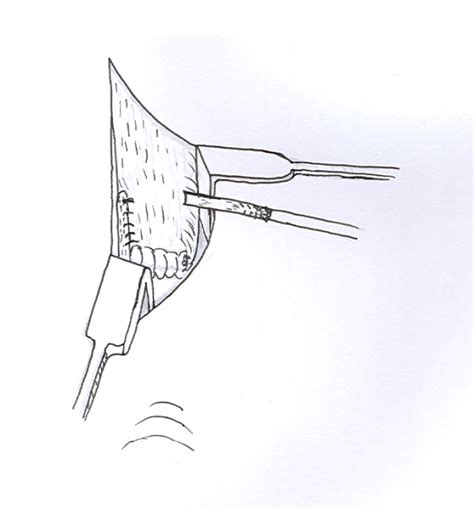 A Locking Suture Is Used To Secure The Graft Tendon To Both Sides Of Download Scientific