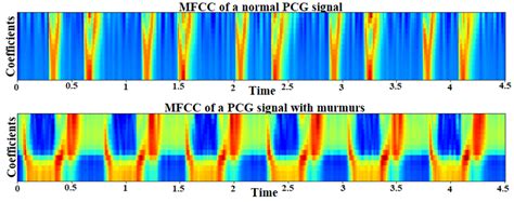 A Mfcc Of A Normal Pcg Signal B Mfcc Of A Pcg Signal With Murmurs
