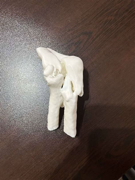 Complex Elbow Fracture Dislocation By Arthrex Makerworld Download Free 3d Models