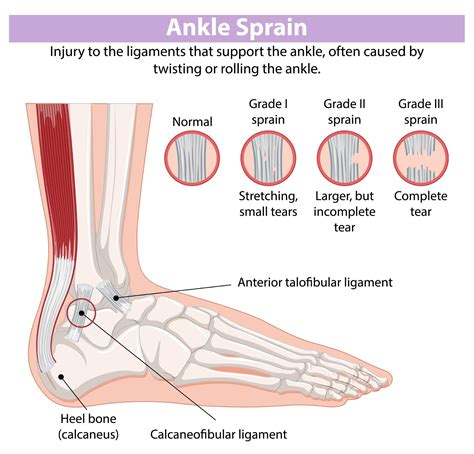 Anatomy Of Ankle Sprain