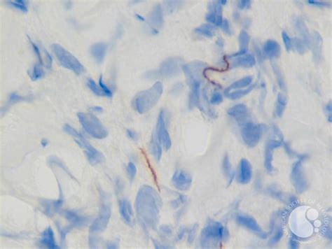 Syphilitic Luetic Lymphadenitis 4