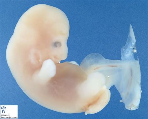 Embryo 17 Weeks Human Pathology