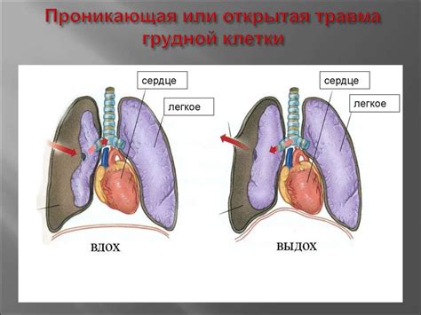 Первая помощь при повреждении грудной клетки и живота презентация онлайн