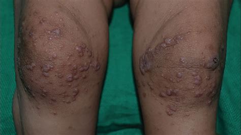 Mild Heat Rash Legs