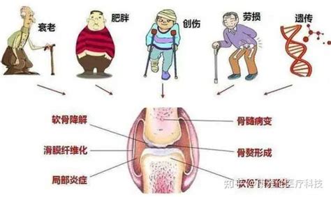 骨关节炎有些什么明显的症状表现？ 知乎