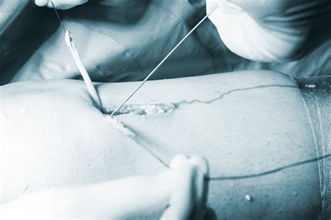 외과 수술 무릎 관절 미세 수술 학 및 정형 외과 극장 응급실을 운영 하는 병원에 간호사에 대한 스톡 사진 및 기타 이미지