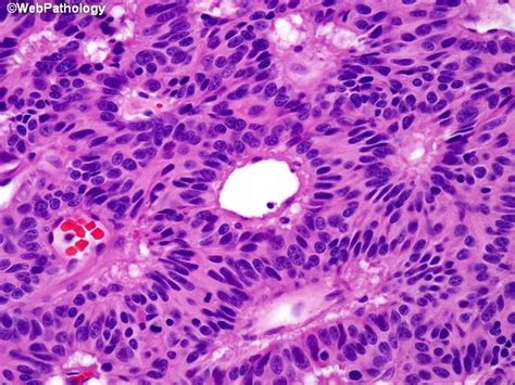 Well Differentiated Neuroendocrine Tumor