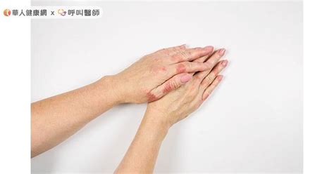 失眠、壓力大害汗皰疹發作，搔癢難耐！吳宛容中醫師：4招防汗皰疹上身 華人健康網 專業即時優質的健康新聞及資訊分享平台業即時優質的健康