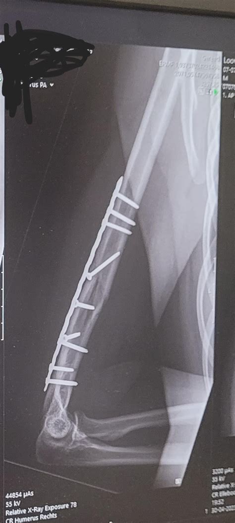 Fractured Humerus 8 5 Weeks Post Break R Brokenbones