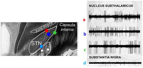 Subthalamic Nucleus Microelectrode Recording Showing Different