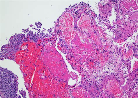 Pathology Outlines Radiation Cystitis