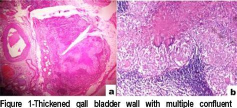 Figure 1 From Tuberculosis Of Gallbladder A Case Report Semantic Scholar