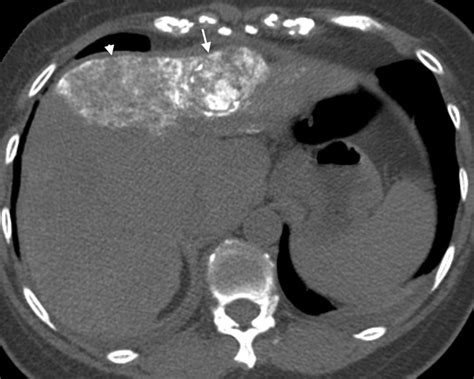 Liver Atlas Diagnosis Transarterial Chemoembolization Tace