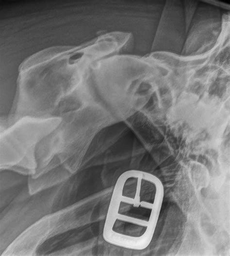 Bone Anomaly On C1 Poll Horse Care Chronicle Forums