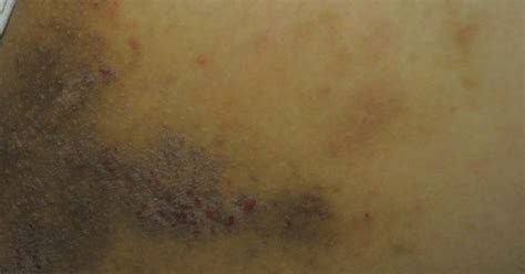 사타구니가 벌겋게 붓는다면 사타구니 습진 의심해야