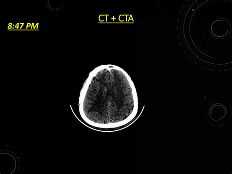 Imaging In Acute Stroke Pptx Heart And Cardiovascular Diseases
