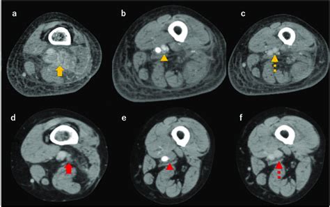 A The Plicated Pva Is Shown And Its Diameter Is 15 Mm Yellow Arrow Download Scientific