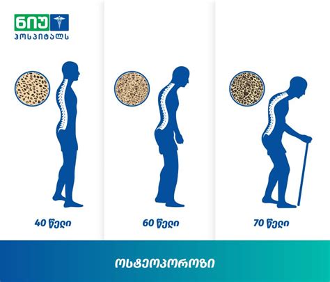 New Hospitals On Linkedin ოსტეოპოროზი ნიუჰოსპიტალსი დენსიტომეტრიული