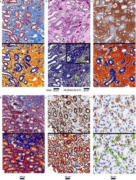 Whole Slide Image Wsi Quantitation Is Shown For A Fibrosis Using