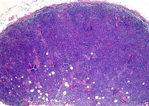 Atypical Lymphocytes Ebv
