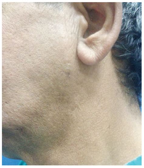 Minimizing The Submandibular Incision In Endoscopic Subcondylar