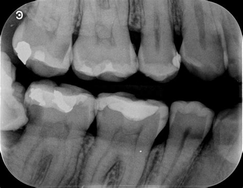 How To Use The Dental Structure Detection Instance Segmentation API