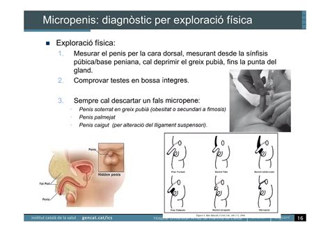 Criptorquidia Micropenis Ginecomàstia I Macroorquidisme 2018 Pdf