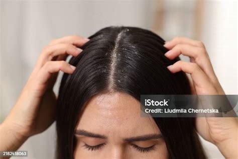 실내에서 머리카락과 두피를 검사하는 여성 클로즈업 비듬 문제 비듬에 대한 스톡 사진 및 기타 이미지 비듬 두피 털 Istock