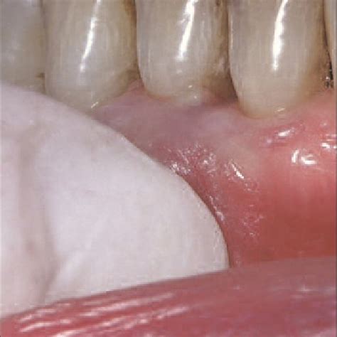 Inflammed Areas Characteristic Of Active Periodontitis Download