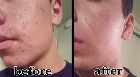How Different Redditors Cleared Their Acne Using Science