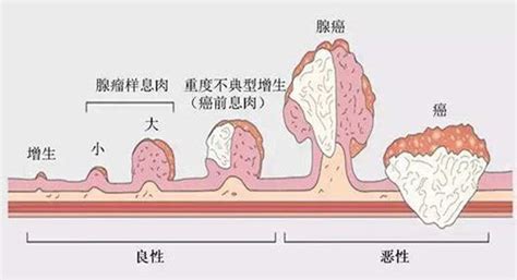 康健园 揭开肠息肉谜团 名栏 新民网 花瓣网