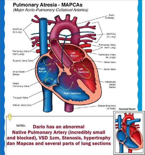 The 23 Best Major Aortopulmonary Collateral Artery Mapcas Images On Pinterest Animation