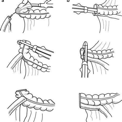 Schematic Diagram Of The Anastomosis Methods A End To Side Anastomosis
