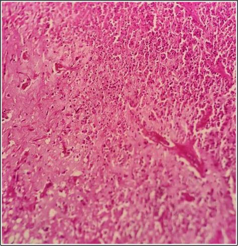 H And E Stain Showing A Highly Cellular High Grade Tumor With