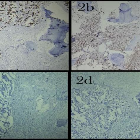 A Immunohistochemically The Carcinomatous Component Shows Positivity