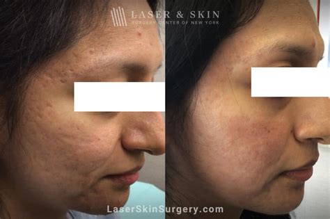 How To Treat Rolling Acne Scars Laser Ny