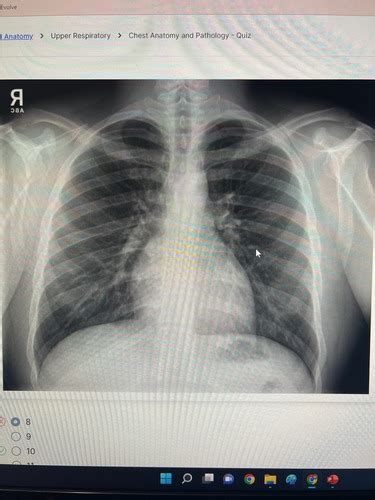 Chest Anatomy And Pathology Flashcards Quizlet