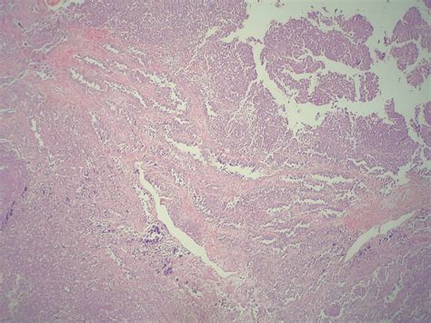 Pathology Educational Groin Mass 8 Yo Girl