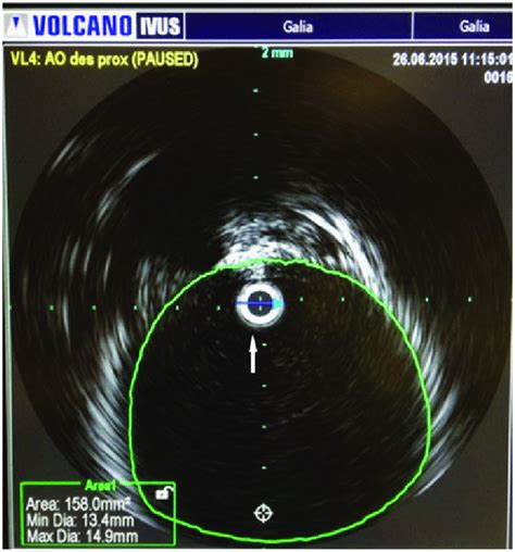 Intravascular Ultrasound Derived Method Of Aortic Distensibility Download Scientific Diagram