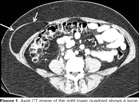 Figure From Anterior Abdominal Wall Intermuscular Giant Lipoma Increased Of Langerhans Cells