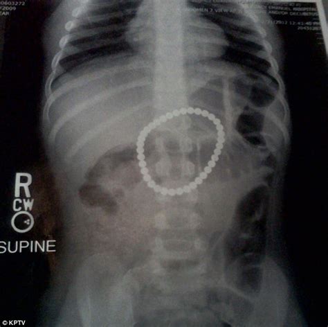 Girl 3 Swallows 37 Magnets Payton Bushnell Hospitalised After