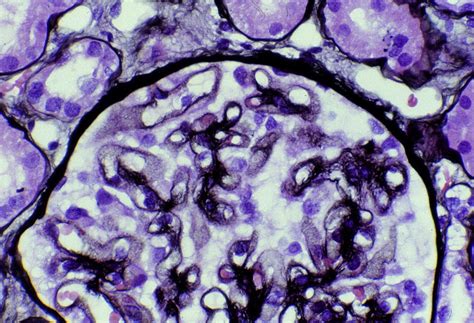 Ajkd Atlas Of Renal Pathology Membranous Nephropathy American