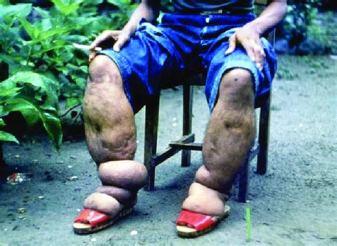 Picture Of Elephantiasis 27 Download Scientific Diagram