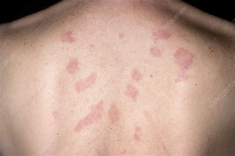 Lupus Erythematosus On The Back Stock Image C0131027 Science