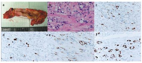 Primary Neuroendocrine Carcinoma Of The Appendix A Case Report And Review Of The Literature