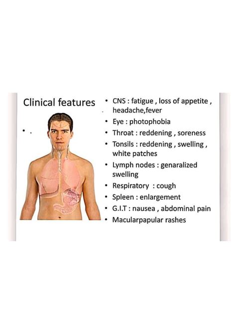 Infectious Mononucleosis Pptx