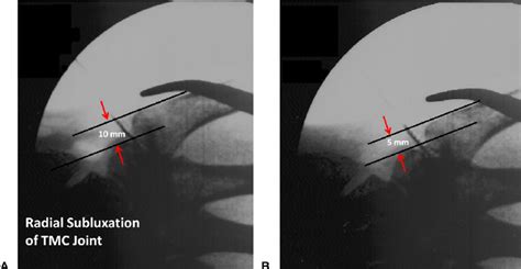 A Typical Anteroposterior Radiograph Showing Subluxation Of The