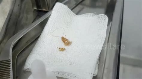 Vietnamese Doctor Extracts Large Cockroach From Womans Inner Ear Buy Sell Or Upload Video